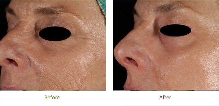 Ablative treatment before and after photo at Dignity Medical Aesthetics ...