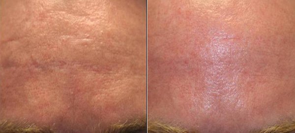 Skin Resurfacing before and after photo at Dignity Medical Aesthetics ...